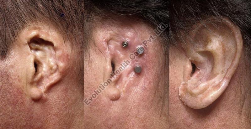 Silicone Ear Prosthesis Manufacturer Supplier from Surat India